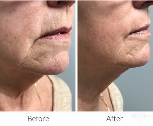 Sylfirm Dual Wave RF Microneedling Manchester, NH