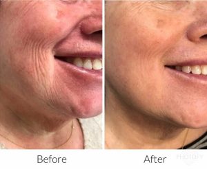 Sylfirm Dual Wave RF Microneedling Manchester, NH