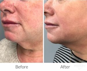 Sylfirm Dual Wave RF Microneedling Manchester, NH